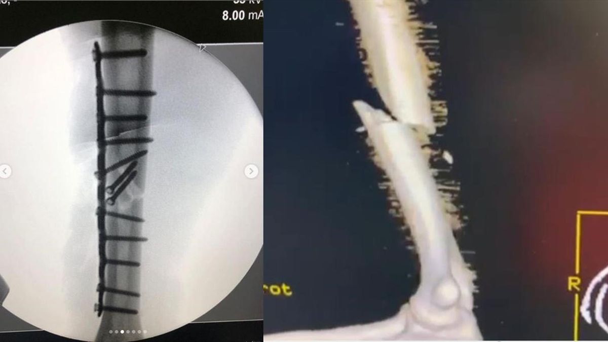 Marc Marquez mostra su Instagram il braccio dopo l'operazione: 12 viti ...