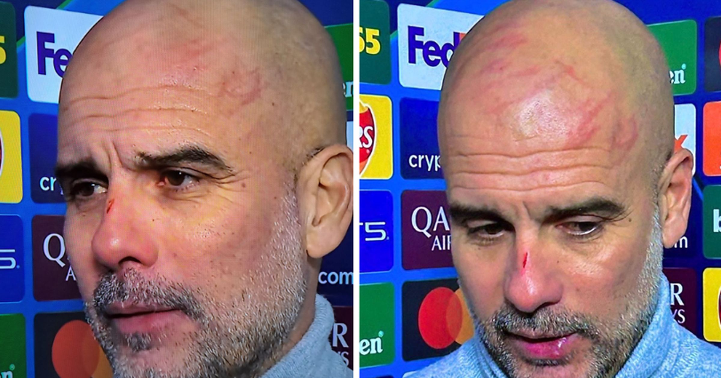 Cosa è successo a Pep Guardiola? Perché ha la faccia piena di graffi ...