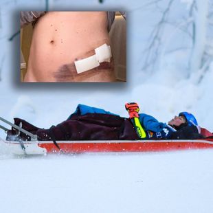 Mikaela Shiffrin zeigt heftige Bilder ihrer Sturzverletzungen: US ...